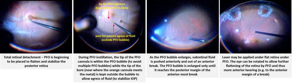 Vitrectomy Basics - Vit Buckle Society