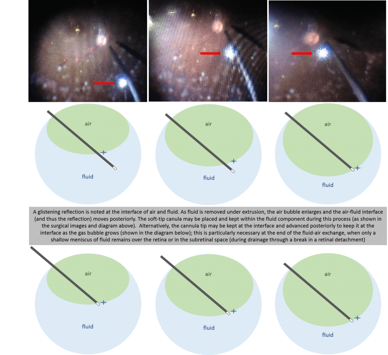 Vitrectomy Basics - Vit Buckle Society