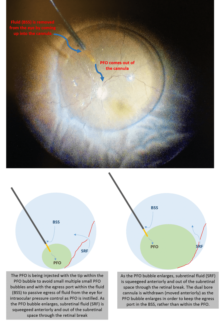 Vitrectomy Basics - Vit Buckle Society